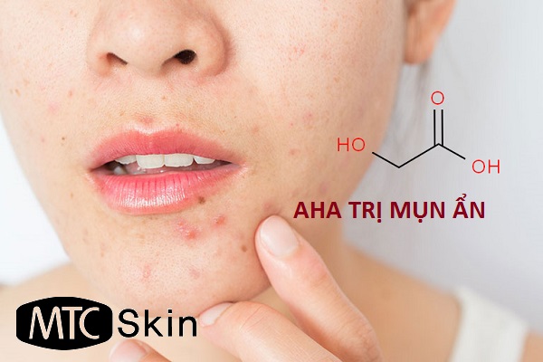 AHA là gì? Tác dụng của AHA đối với làn da và cách dùng hiệu quả